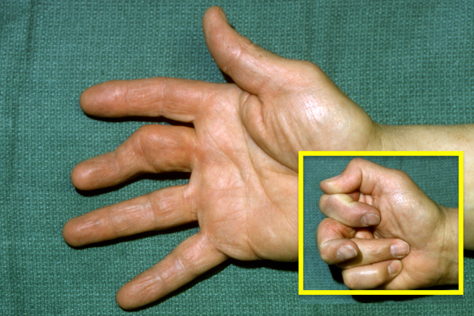 Osteoarthritis Fingerthumb Mp Pip Dip And Ip Hand Surgery Resource